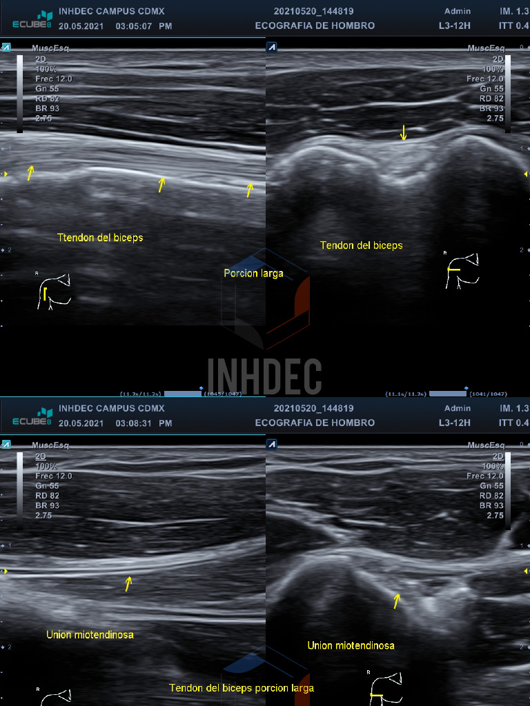 Imagenes Ecografia de Hombro | PDF