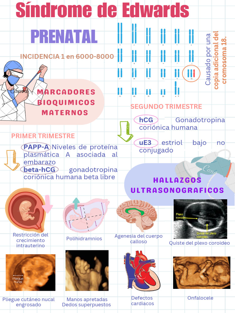 Síndrome de Edwards y marcadores prenatales | PDF