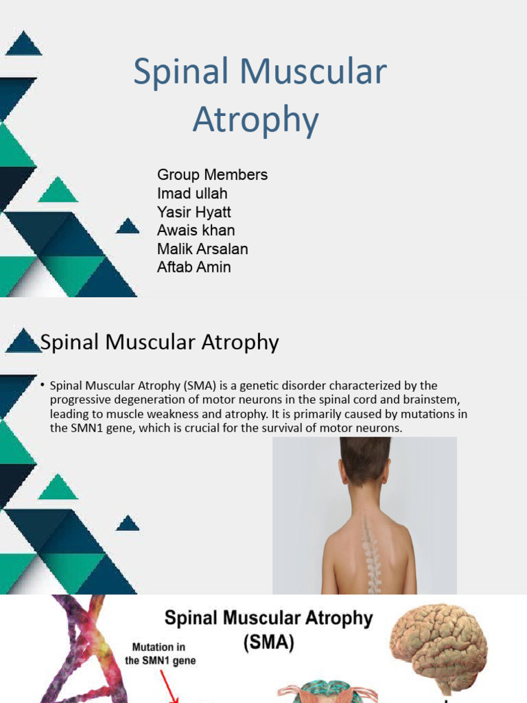 Understanding Spinal Muscular Atrophy | PDF | Human Diseases And ...