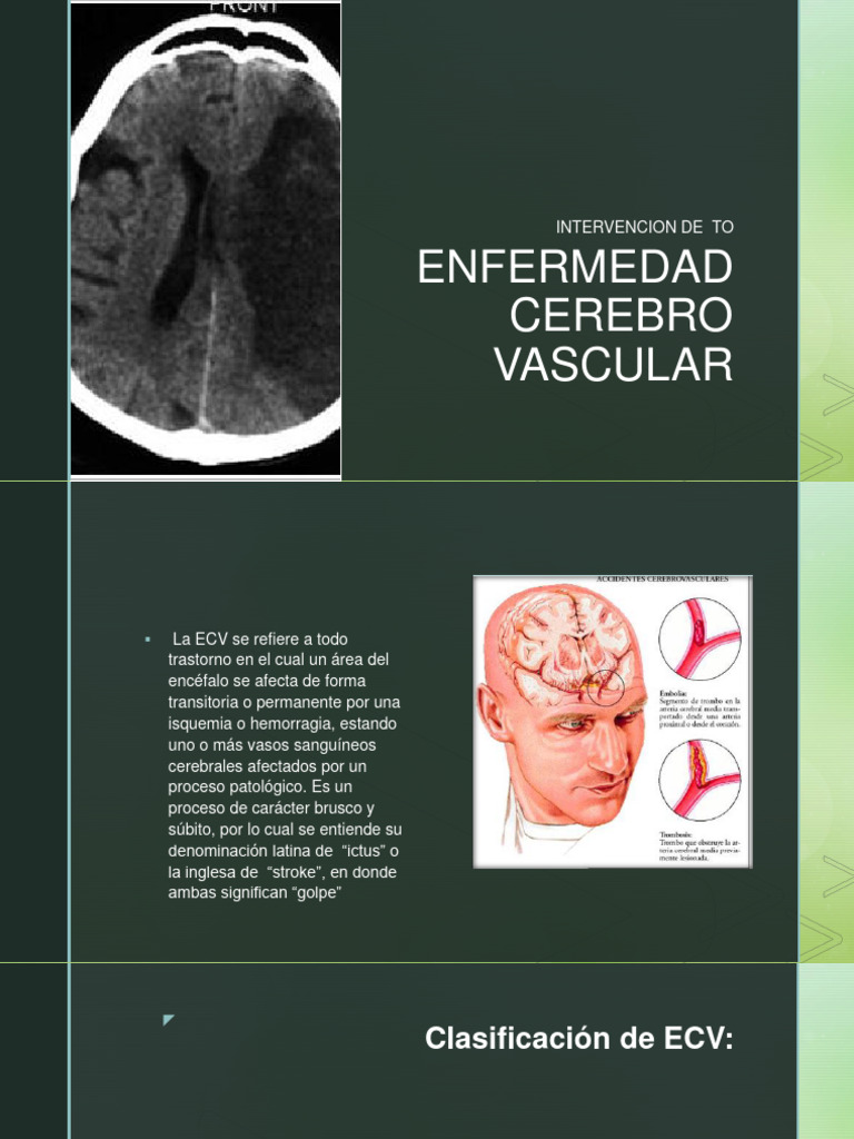 Enfermedad Cerebro Vascularsf | PDF | Isquemia | Carrera
