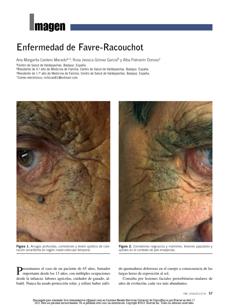 Enfermedad de Favre-Racouchot. Acne | PDF | Medicina CLINICA | Medicina