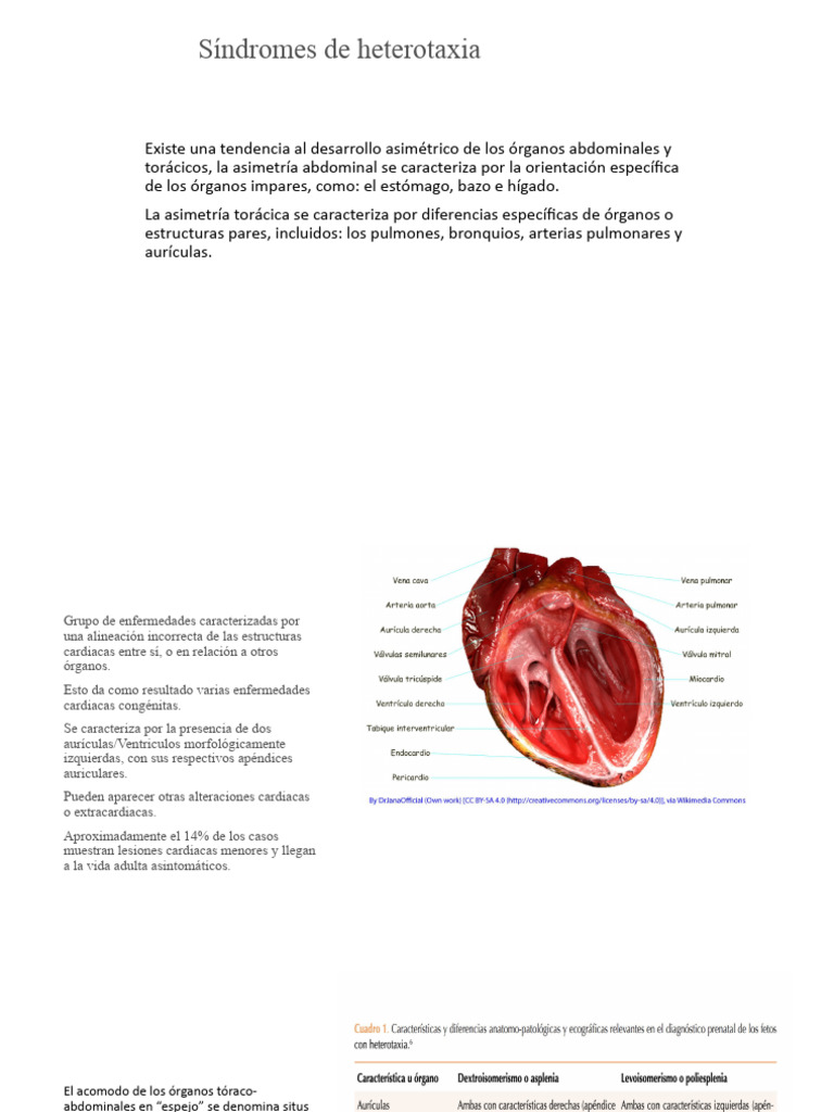 Síndromes de Heterotaxia: Asimetría Orgánica | PDF | Ventrículo ...