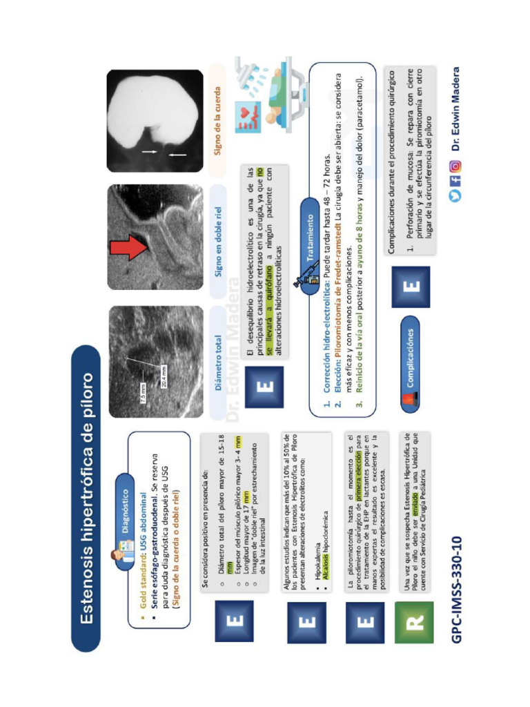 Estenosis Hipertrofica Del Piloro | PDF