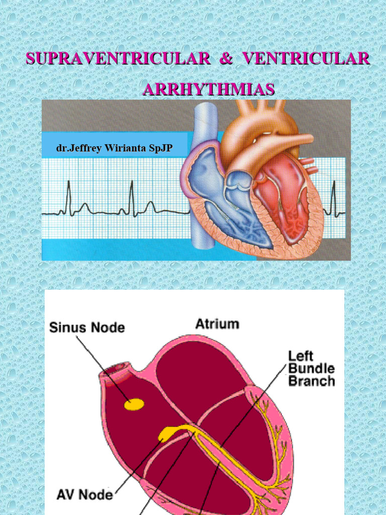 ECG, SV & Ventr Arrhythmias | PDF