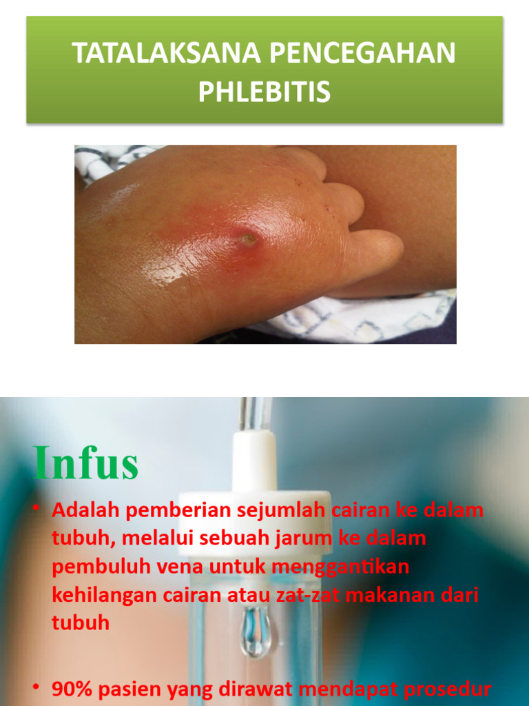 Tatalaksana Pencegahan Plebitis | PDF