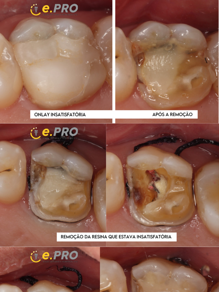 Sequencia de Preparo Onlay | PDF