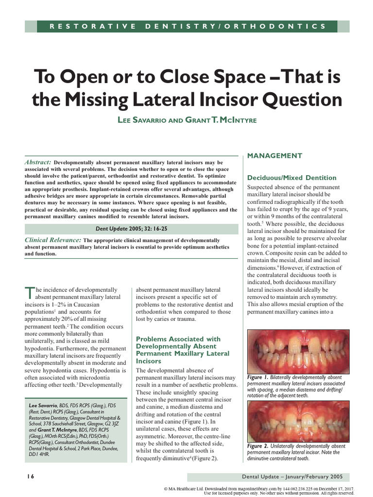 Missing Lateral | PDF | Orthodontics | Dental Implant