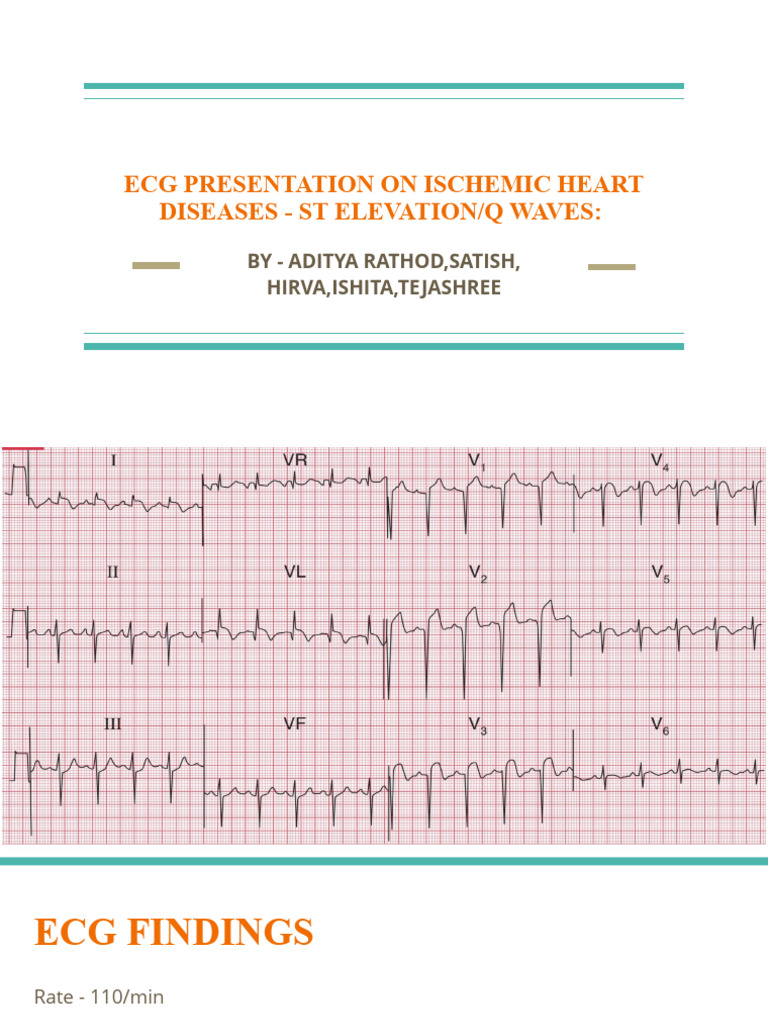 ECG Presentation by ADITYA (2023-24) | PDF