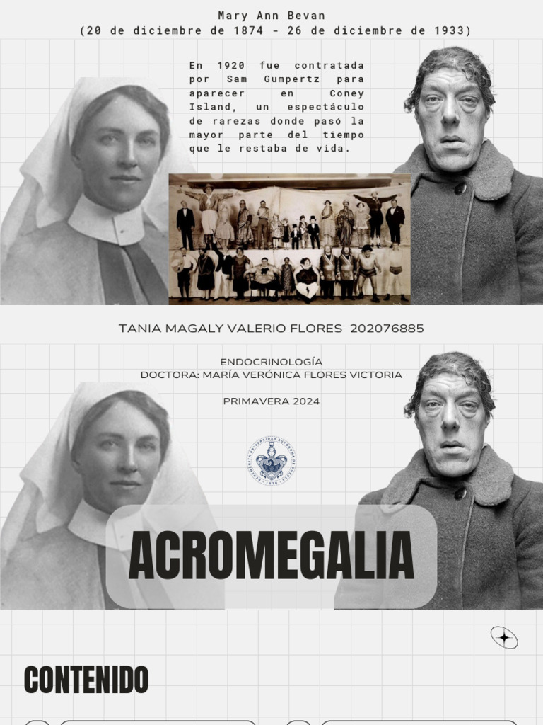 Acromegalia: Diagnóstico y Tratamiento | PDF | Neoplasias | Medicina ...