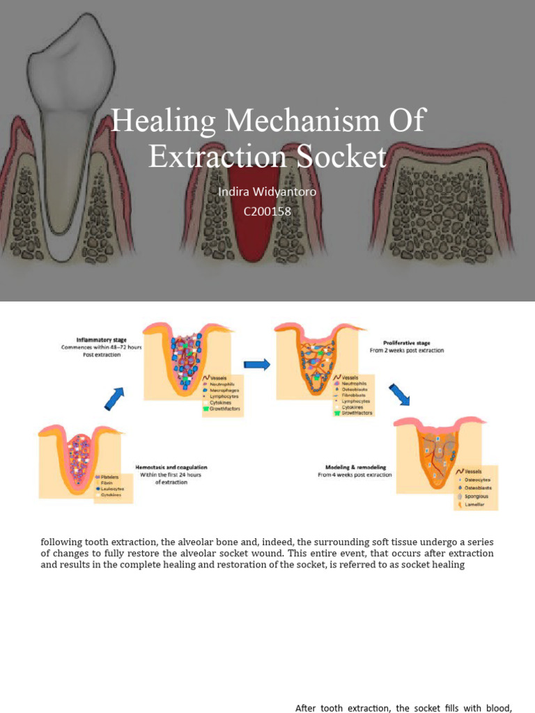 Healing Mechanism of Extraction Socket | PDF | Bone | Coagulation