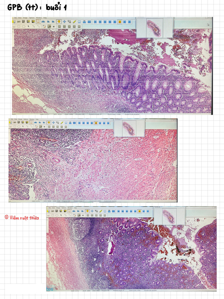 B1. Viêm (GPB) | PDF