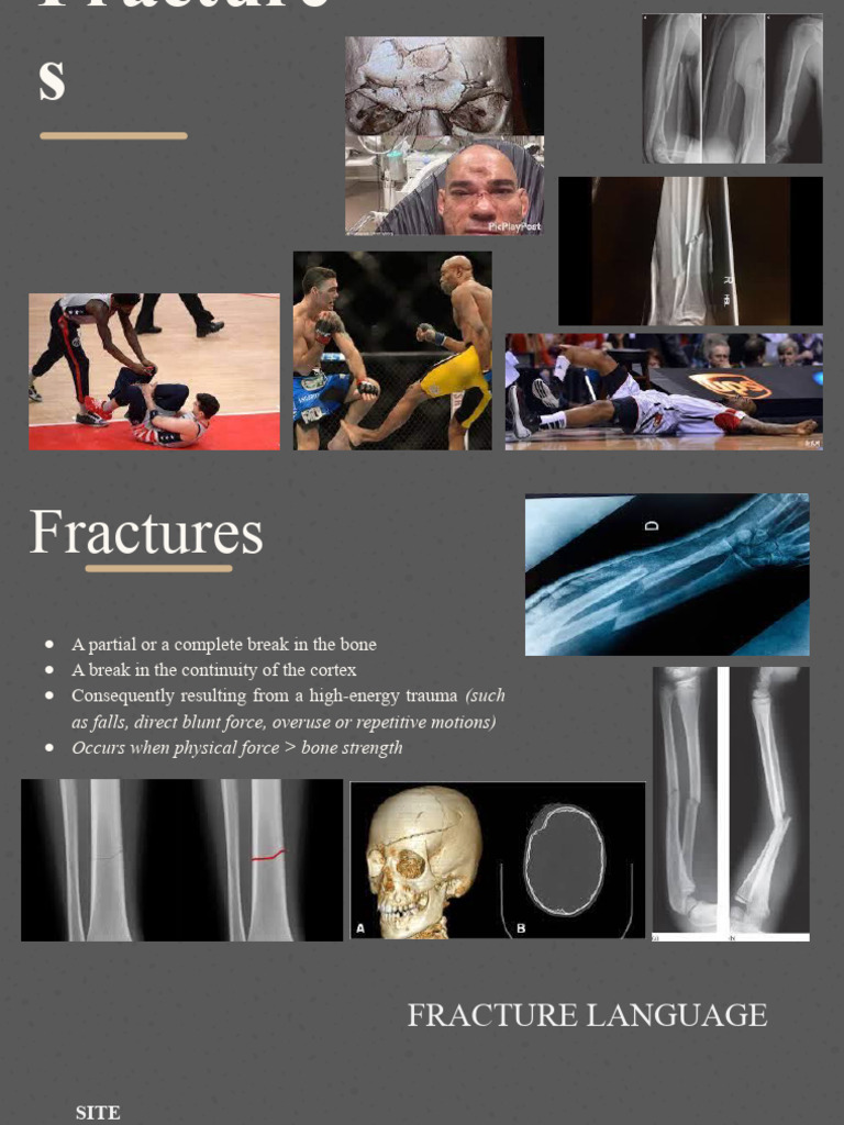 Fractures | PDF | Vertebral Column | Musculoskeletal System