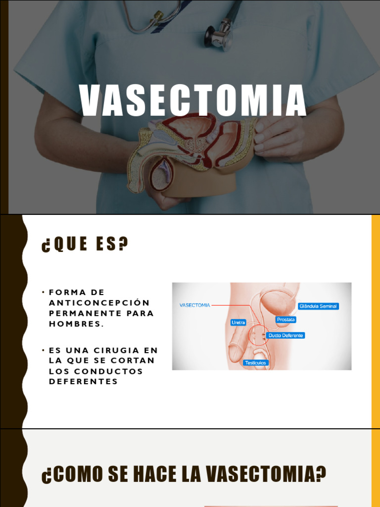Guía Completa sobre Vasectomía | PDF