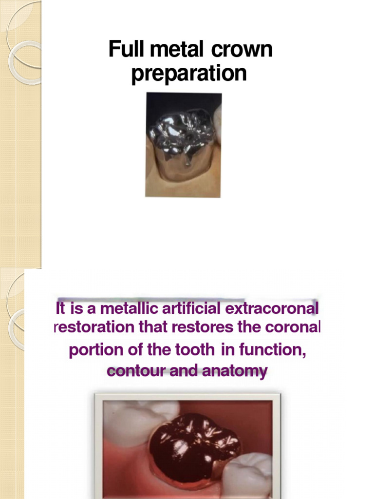 4 - (+) Full Veneer Metal Crown | PDF | Human Tooth | Dental Anatomy