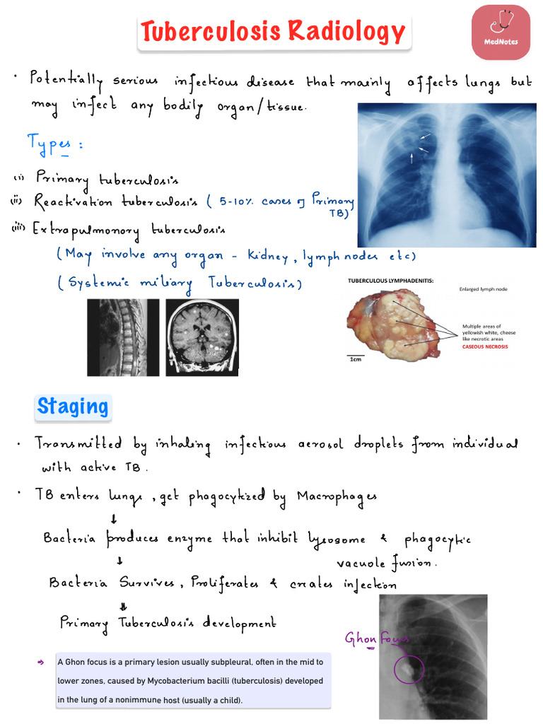 3. Tuberculosis Radiology | PDF | Tuberculosis | Immunology