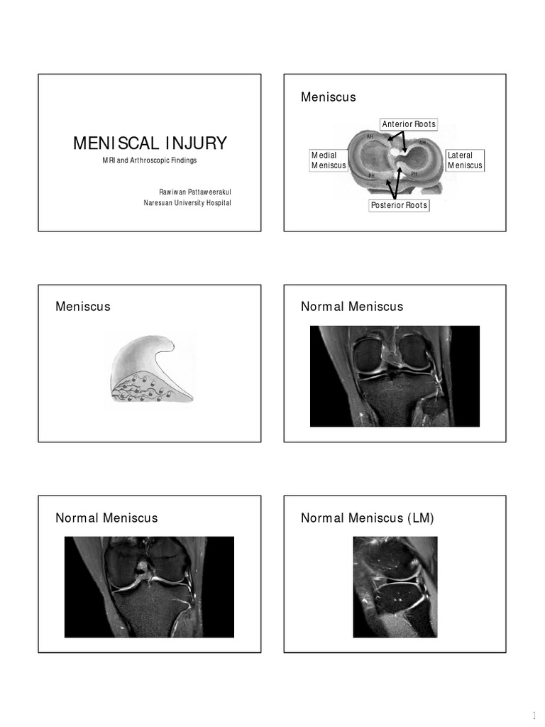 Meniscal Injury Handout | PDF | Knee | Joints