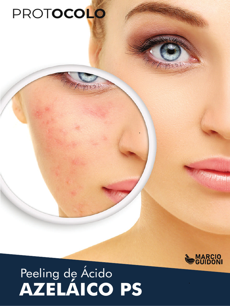 Protocolo de Peeling com Ácido Azeláico | PDF