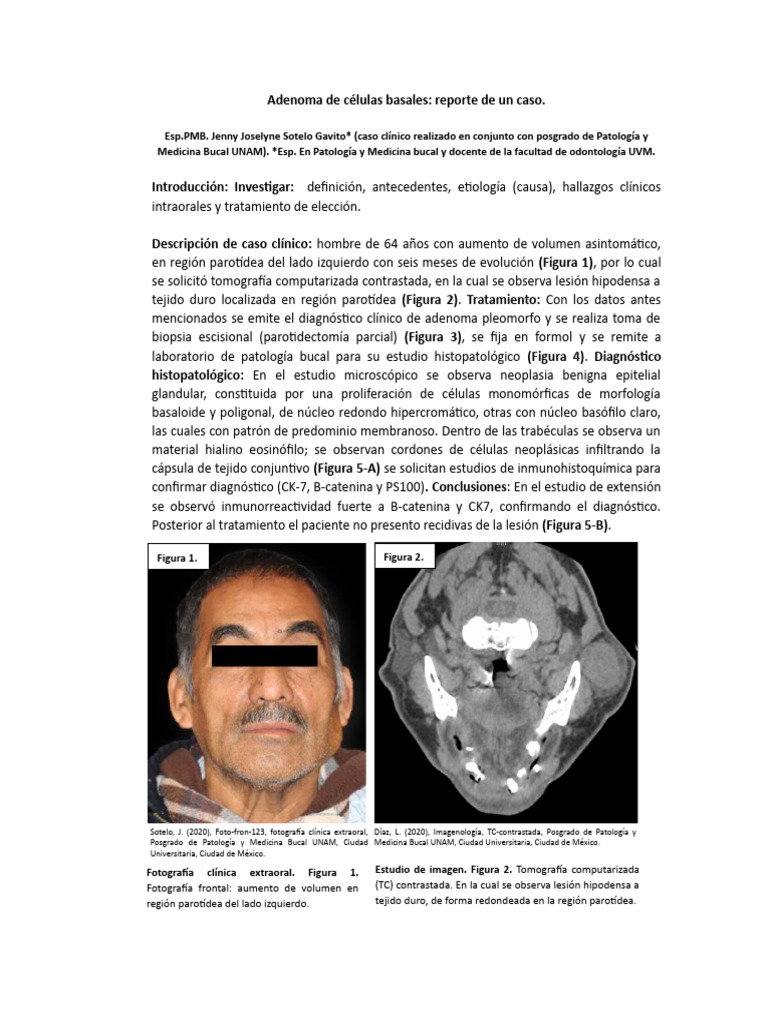 Cartel - Adenoma de Células Basales - UVM - Paulina. | PDF | Patología ...