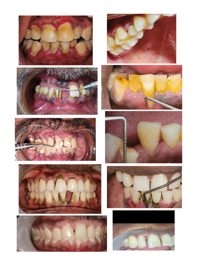 Perio Pictures Final | PDF