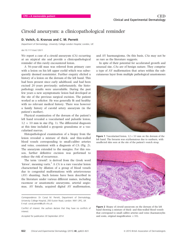 Cirsoid Anurism A Clinicopathological Reminder Veitch2015 | PDF | Vein ...