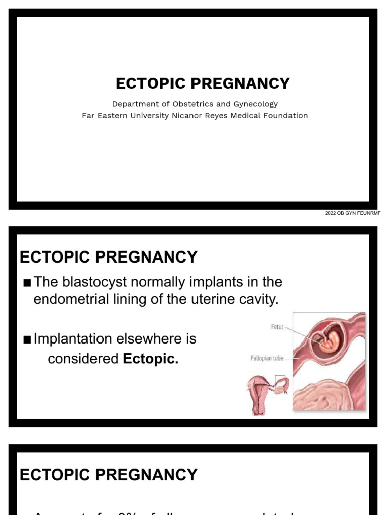 Chapter 12 Ectopic Pregnancy EPP 1 1 | PDF
