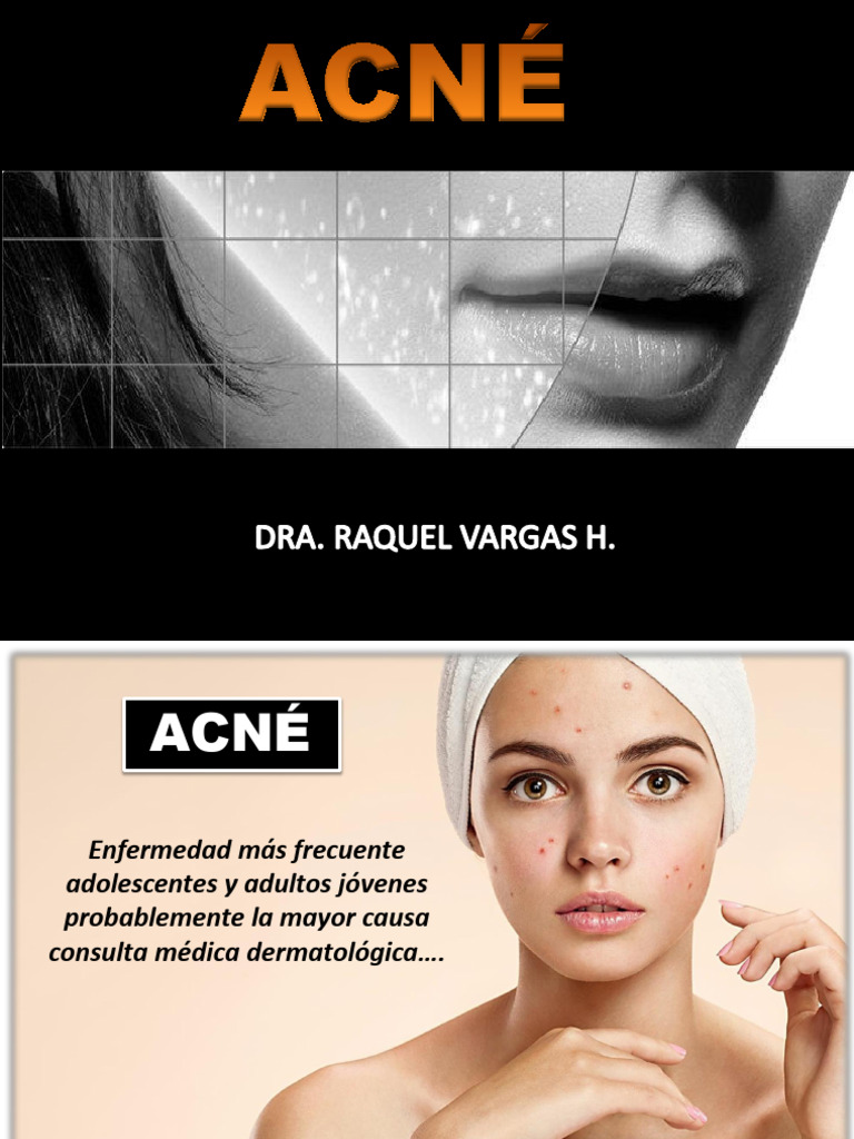 ACNE | PDF