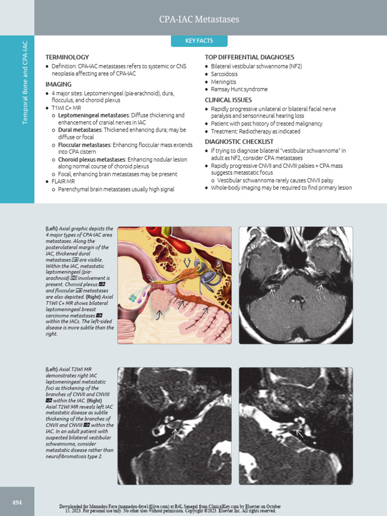 Cpa Iac Metastases | PDF
