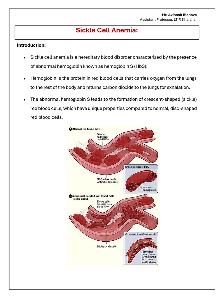 Sickle Cell Anemia | PDF