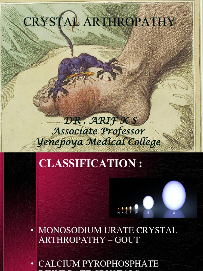 Arif K S Presentation Final 2 | PDF | Gout | Clinical Medicine