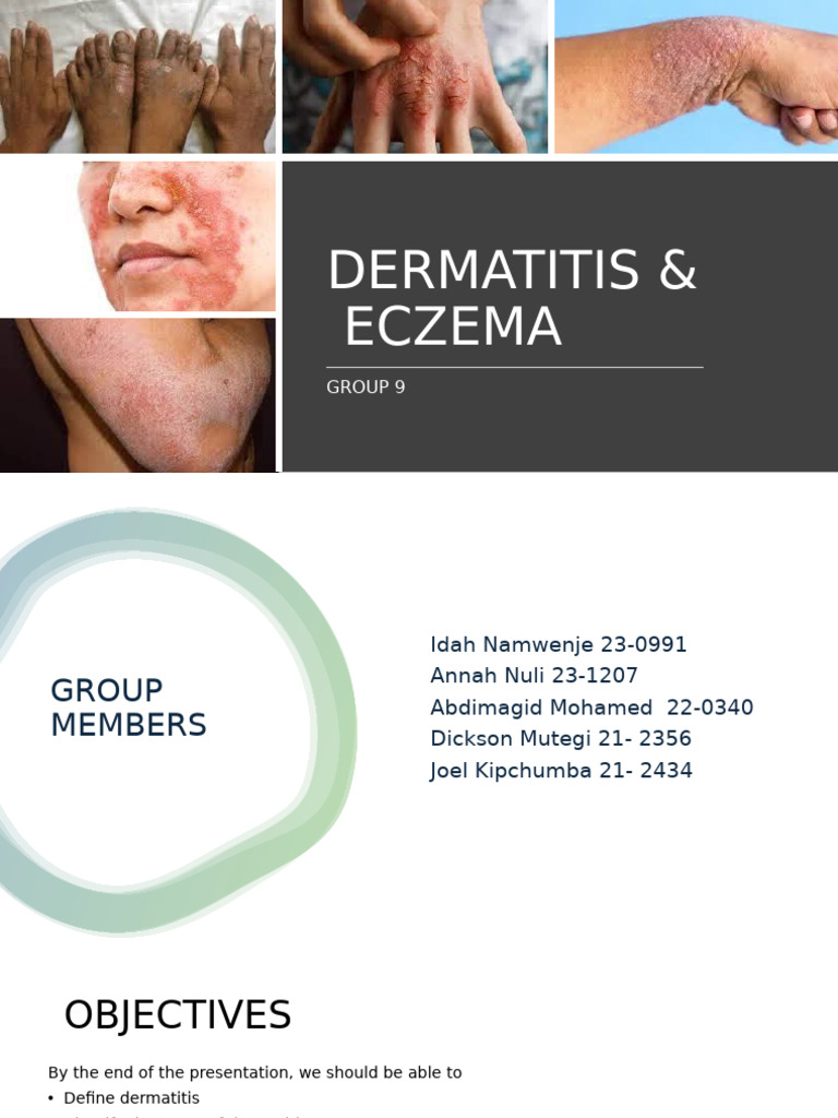 Dermatitis and Eczema | PDF