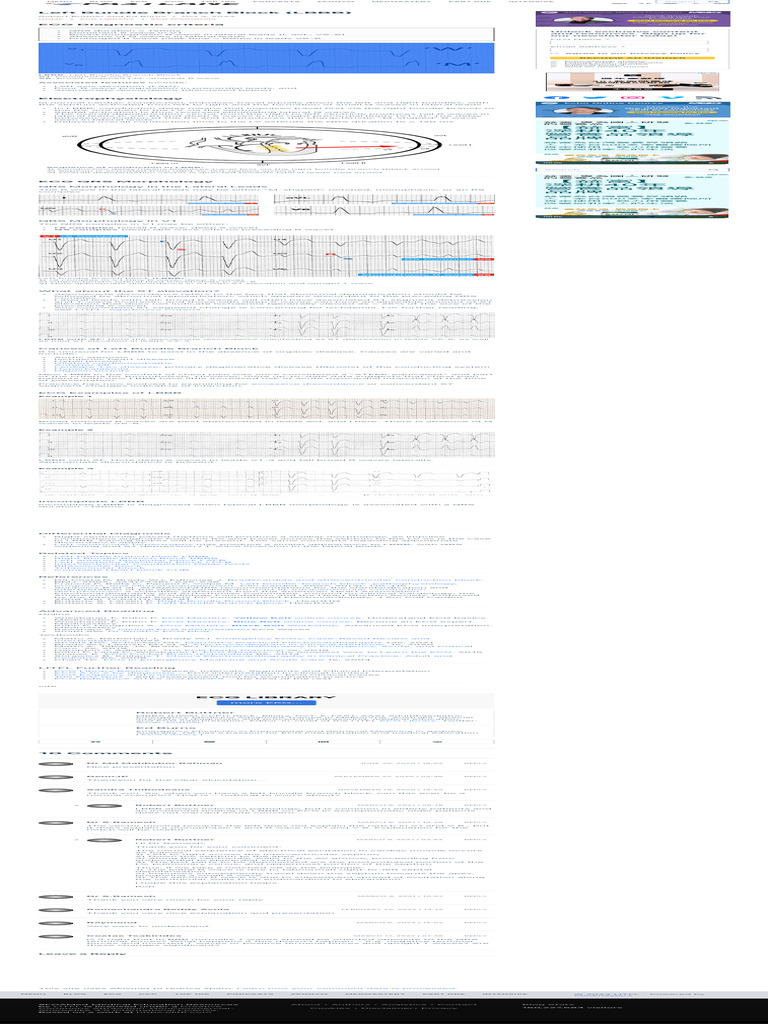 Left Bundle Branch Block (LBBB) - LITFL - ECG Library Diagnosis | PDF