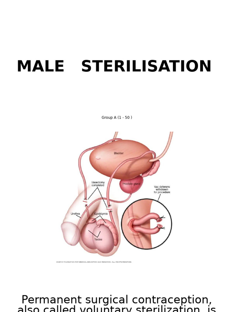 Vasectomy | PDF