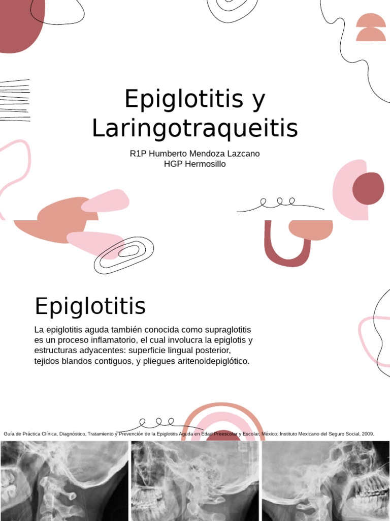 Epiglotitis Laringotraqueitis | PDF