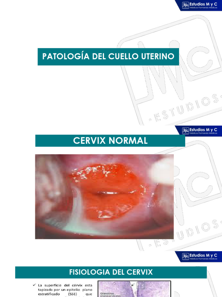 Ca Cuello Uterino | PDF