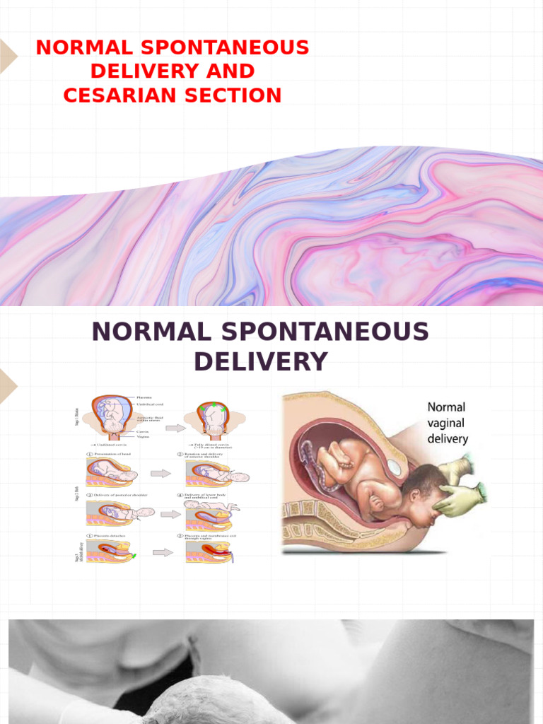 Normal Spontaneous Delivery and Cesarian Section | PDF