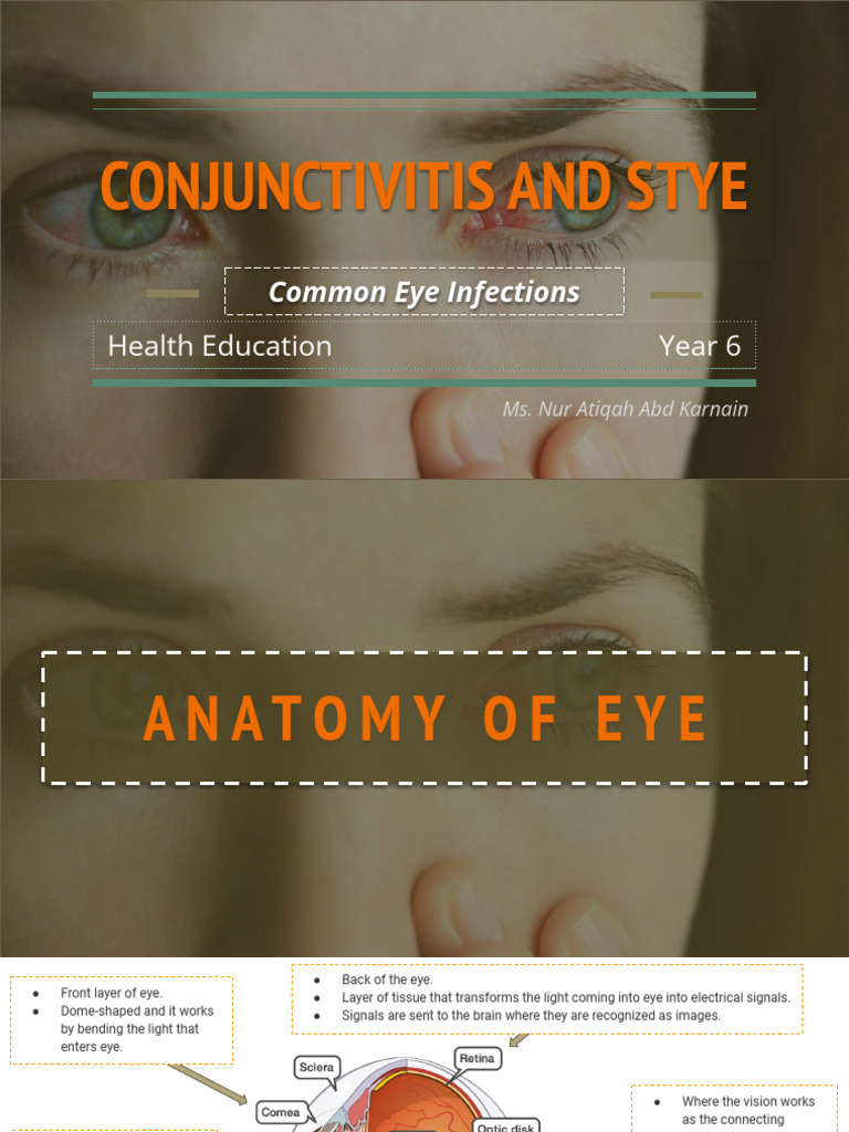 Health Education: Year 6 - Conjunctivitis and Stye | PDF ...