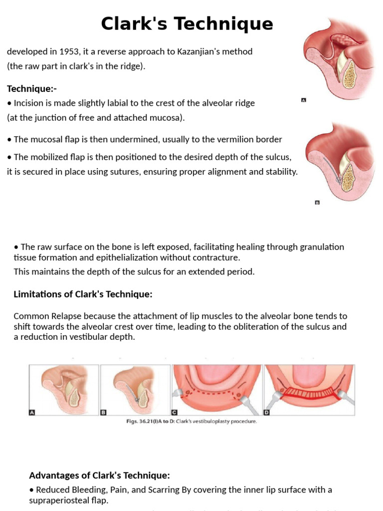 Clark's Technique | PDF