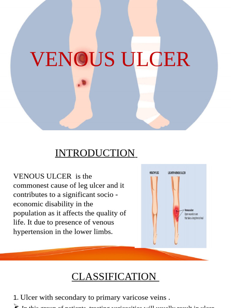 Venous Ulcers | PDF