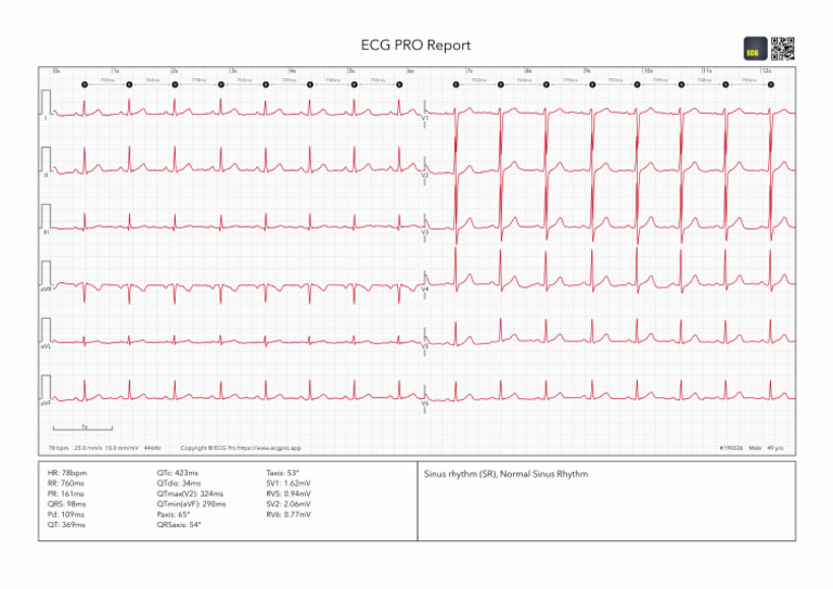 ECG Pro Report 190026 | PDF