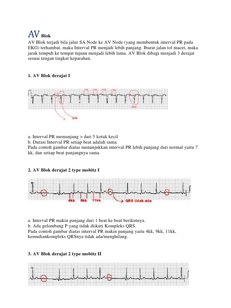 Jenis dan Derajat AV Blok pada EKG | PDF
