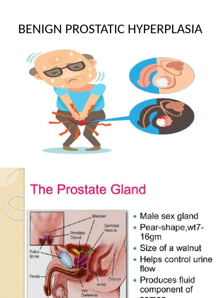 Benign Prostatic Hyperplasia | PDF