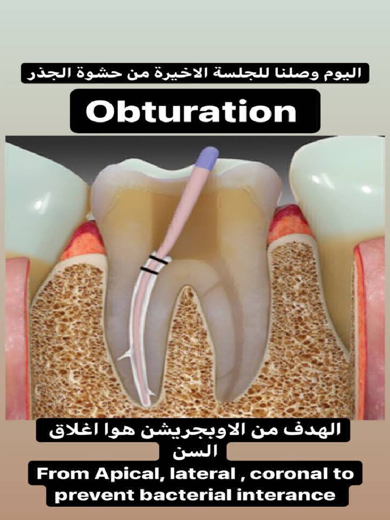 Obturation | PDF