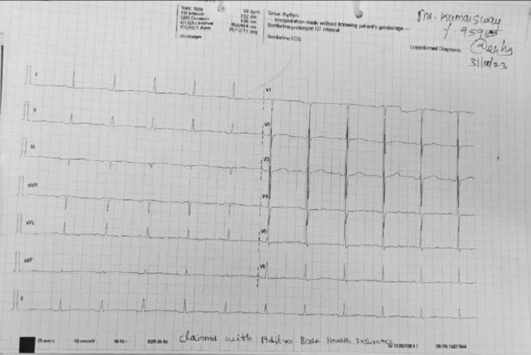 ECG Report 2 | PDF