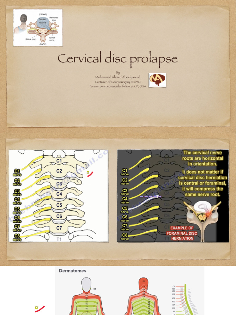 Cervical Disc Prolapse | PDF | Nervous System | Medical Specialties