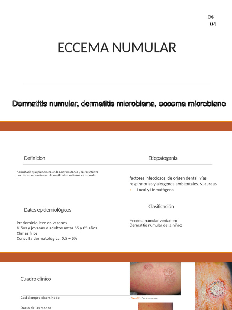 Dermatitis Atópica y Eccema Numular | PDF