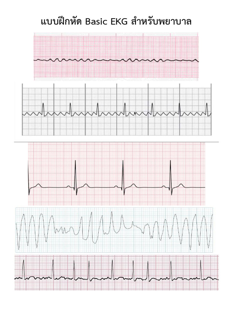 แบบฝึกหัด Basic EKG สำหรับพยาบาล | PDF