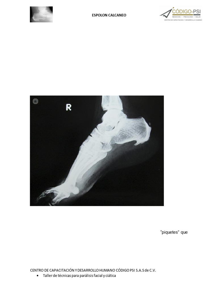 TX para Espolon Calcaneo | PDF | Pie | Salud y bienestar