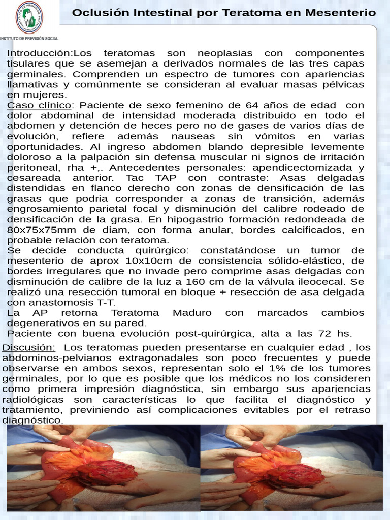 Teratoma | PDF