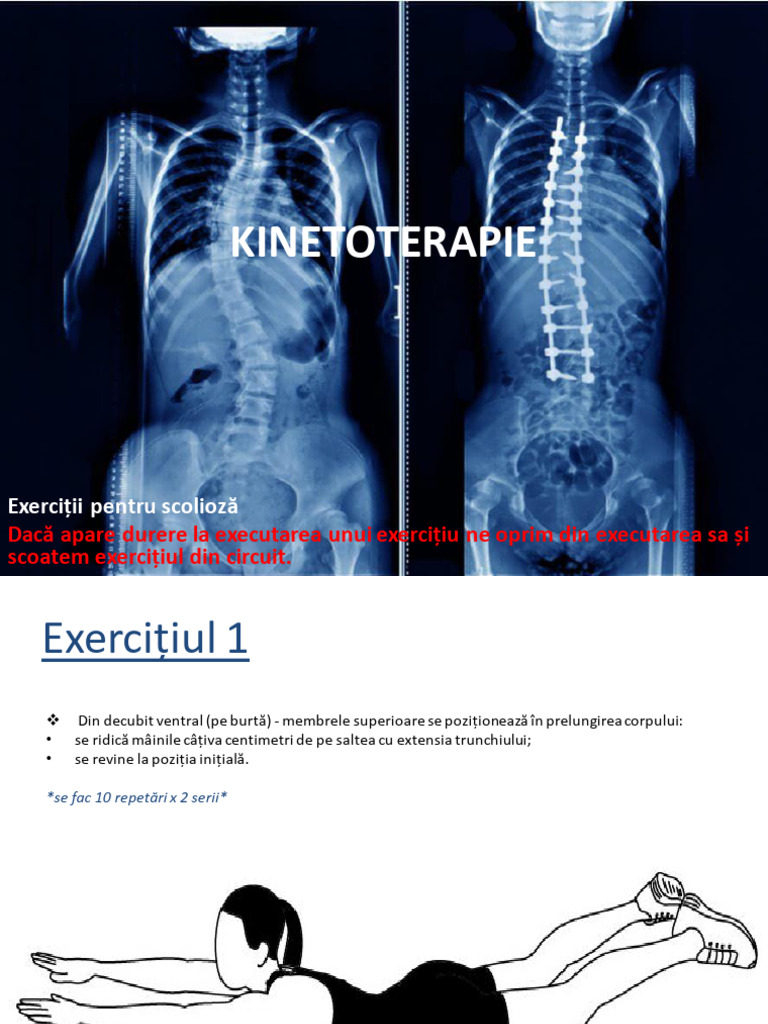 Exercitii Scolioza | PDF