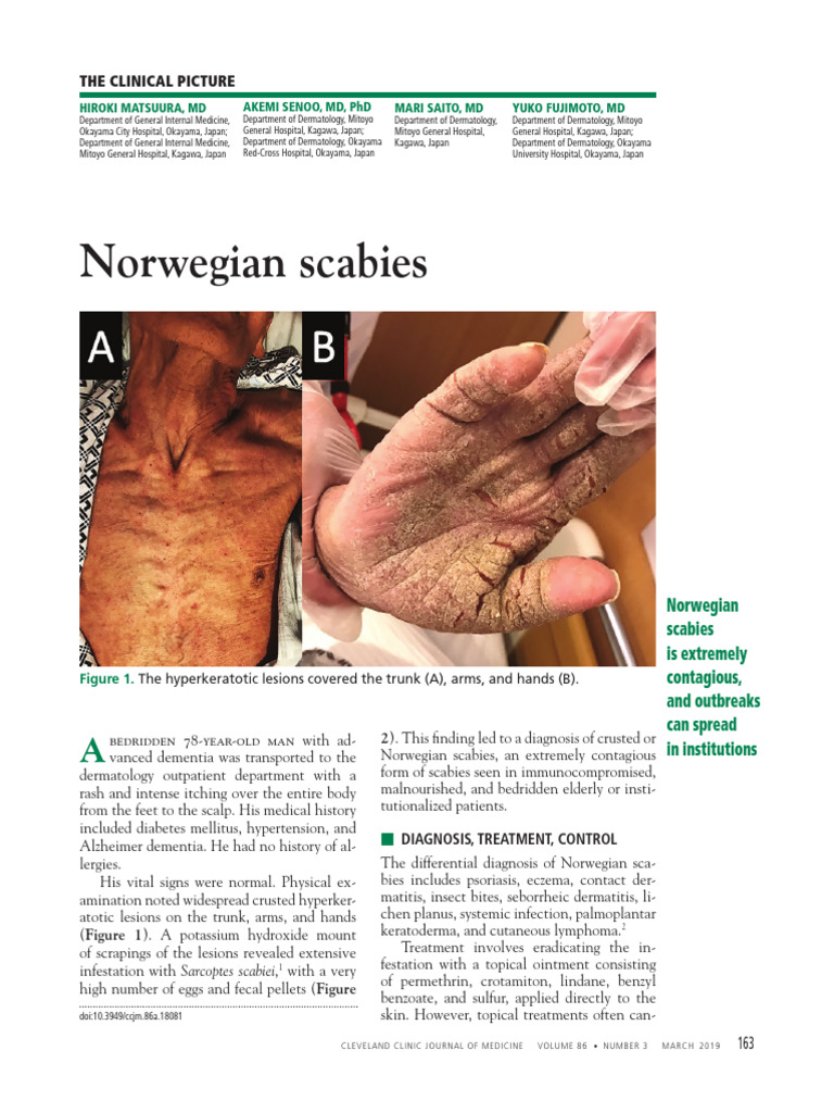 Norwegian Scabies | PDF